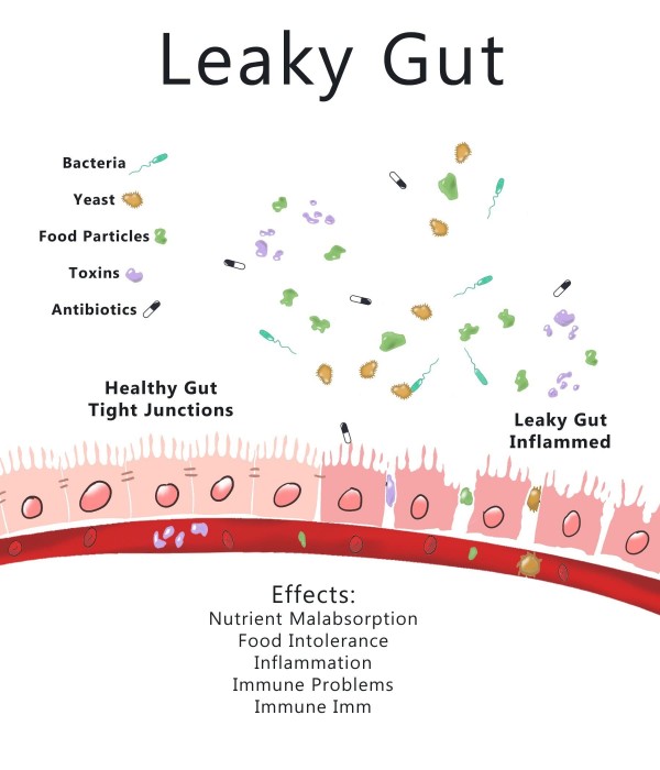 Blogs Addlife - 10 Signs of Leaky Gut
